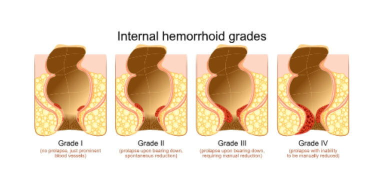 Hemorrhoid Treatment - Dr Farah Beshoy