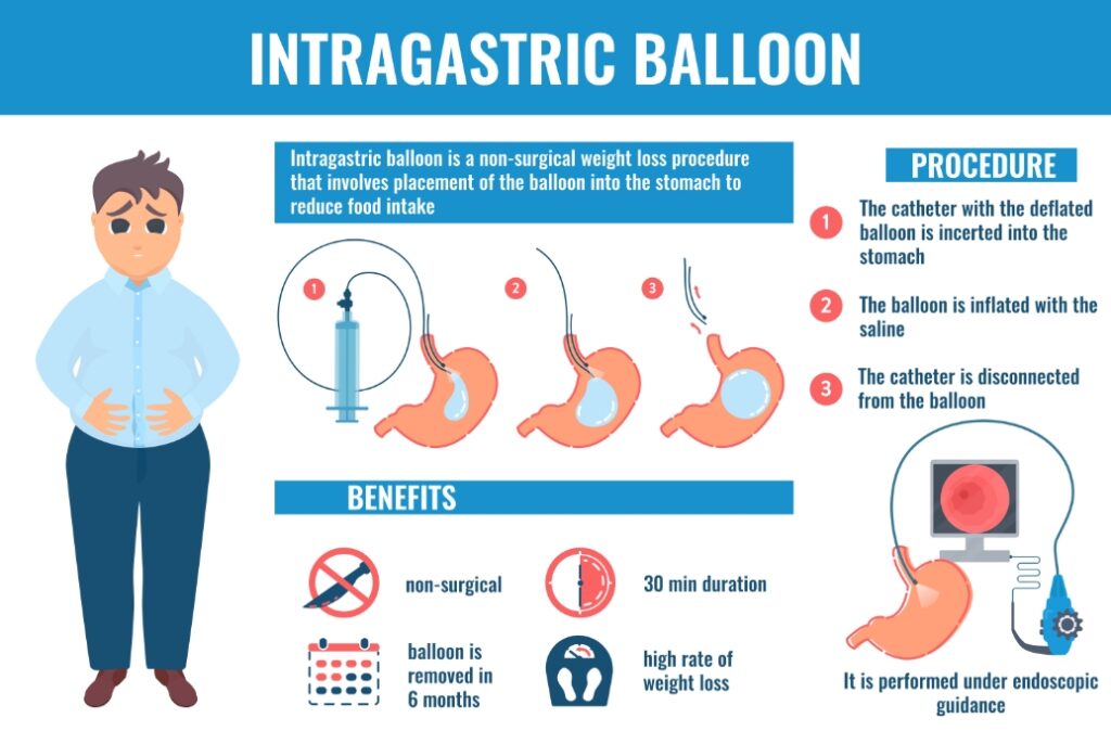 Endoscopically Inserted Intragastric Balloons - Dr Farah Beshoy